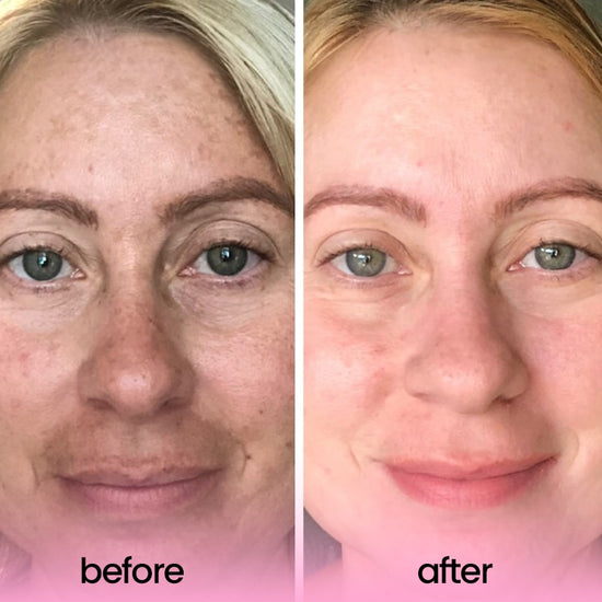 Turmeric Kojic Acid Pads – Neously